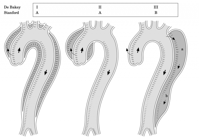 Dissecção de aorta: diagnóstico e tratamento