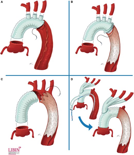 Abordagens Cirúrgicas do Arco Aórtico – Brazilian Journal of ...